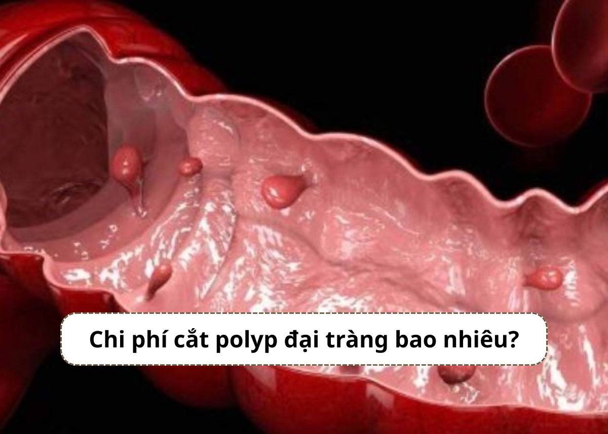 Chi phí cắt polyp đại tràng hết bao nhiêu? Các yếu tố ảnh hưởng đến chi phí