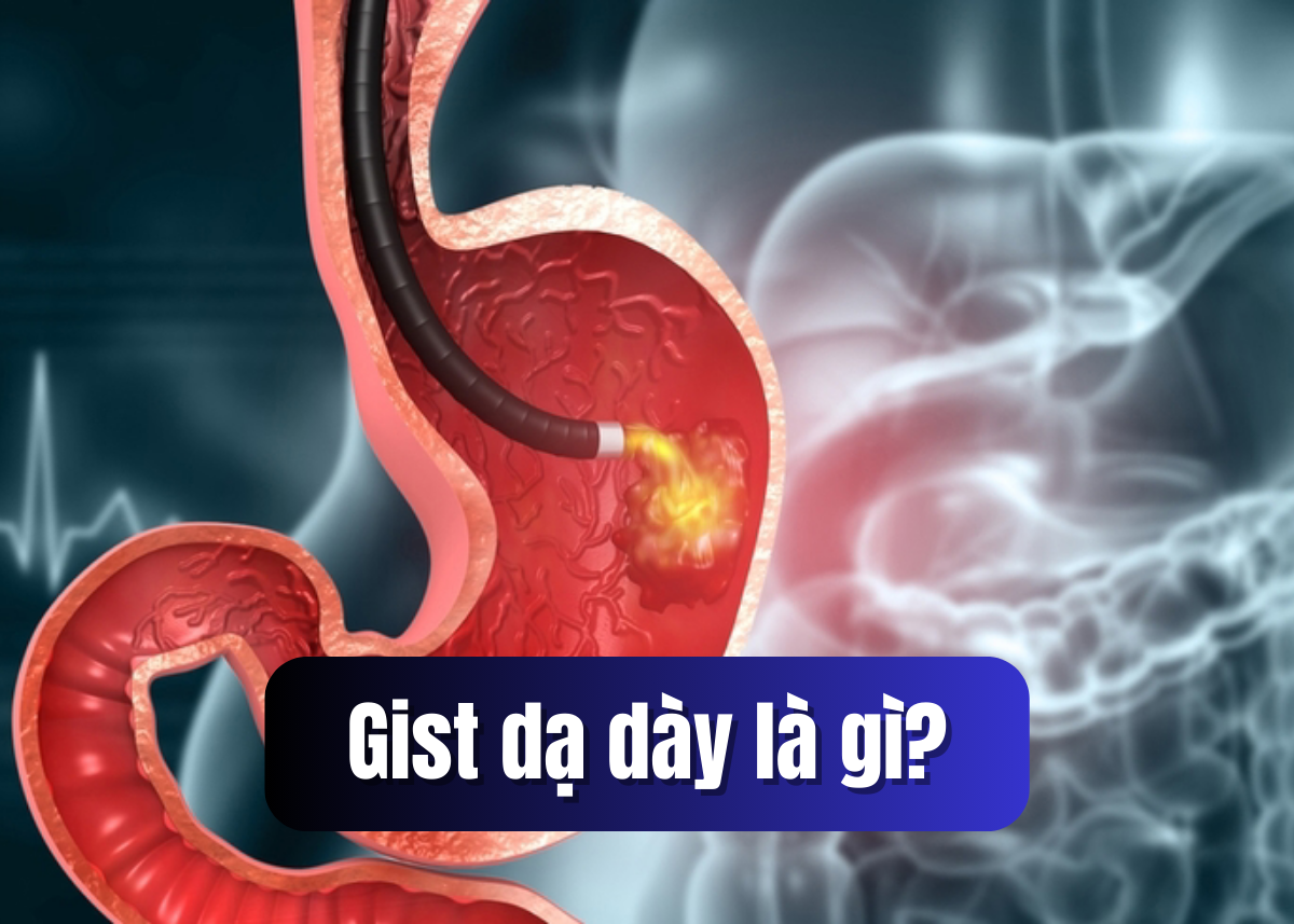 Gist dạ dày là gì? Nguyên nhân, triệu chứng và phương pháp điều trị bệnh