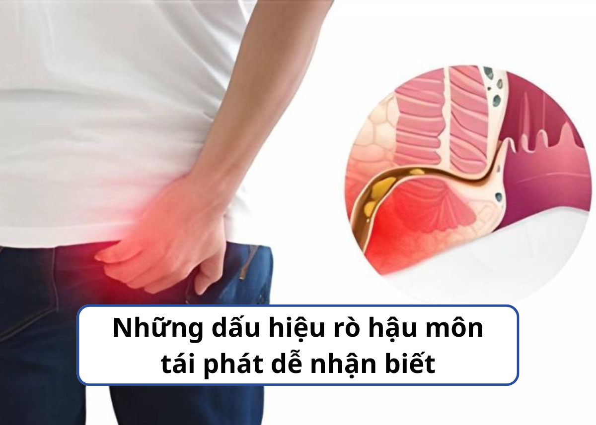 Những dấu hiệu rò hậu môn tái phát và cách xử lý